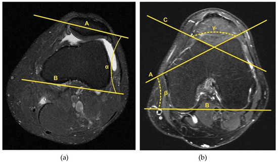 MRI Characteristics and Alterations in Patellar Height in Patients with ...