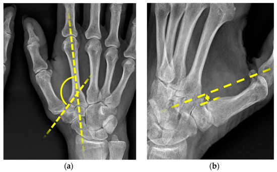 Radiological Influencing Factors in the Diagnosis of Painful Habitual ...