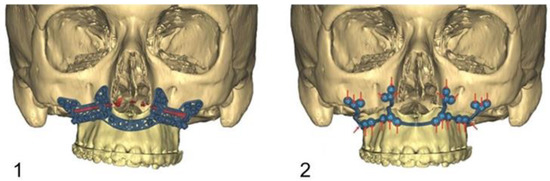 Dental Root Injuries Caused by Osteosynthesis Screws in Orthognathic ...