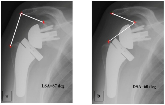 Preoperative Planning for Reverse Shoulder Arthroplasty: Does the ...