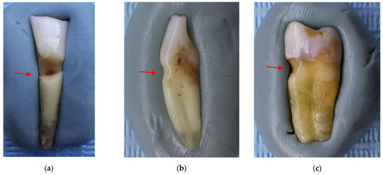 Morphological and Optical Coherence Tomography Aspects of Non-Carious ...