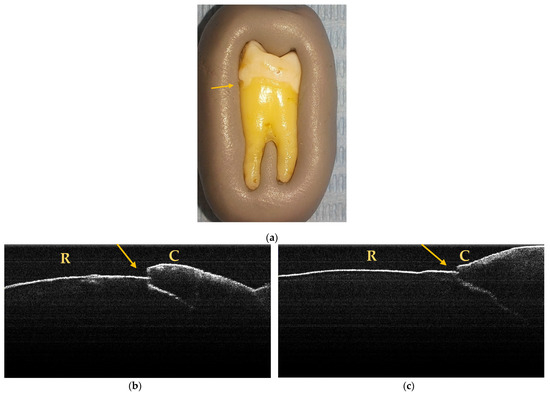 Morphological and Optical Coherence Tomography Aspects of Non-Carious ...