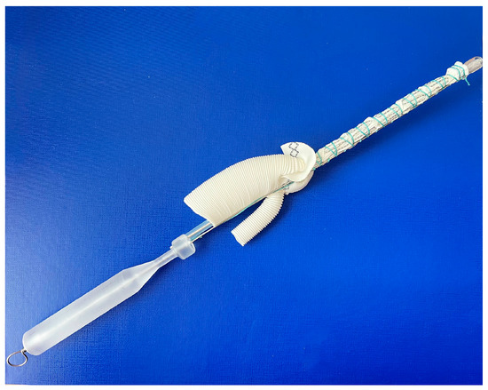 Frozen Elephant Trunk for Aortic Dissection Using Different Hybrid ...