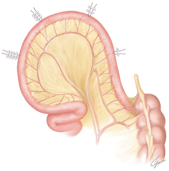 Robot-Assisted Radical Cystectomy with Modified Vesica Ileale Padovana (VIP) Neobladder ...