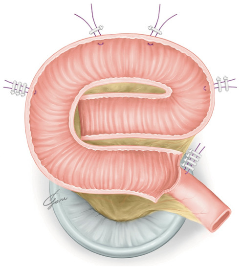 Robot-Assisted Radical Cystectomy with Modified Vesica Ileale Padovana ...