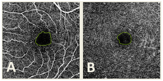 A Reliable Criterion for the Correct Delimitation of the Foveal ...