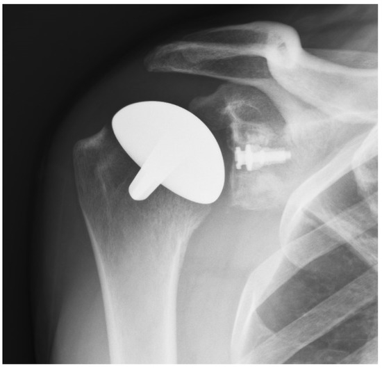 Cementless Metal-Free Ceramic-Coated Shoulder Resurfacing