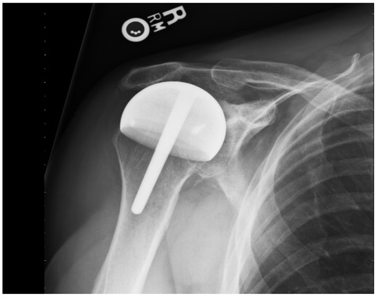 Cementless Metal-Free Ceramic-Coated Shoulder Resurfacing