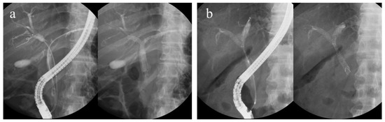 Endoscopic Transpapillary Stenting for Malignant Hilar Biliary ...