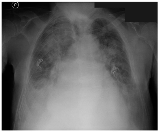 Open-Heart Cardio-Thoracic Biological Valve Replacement Following ...