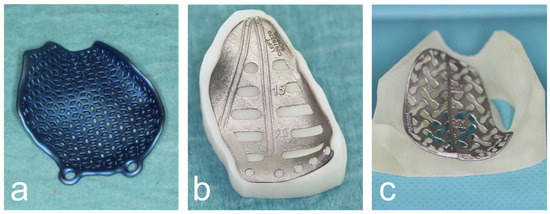 Comparison of Anatomical Preformed Titanium Implants and Patient ...