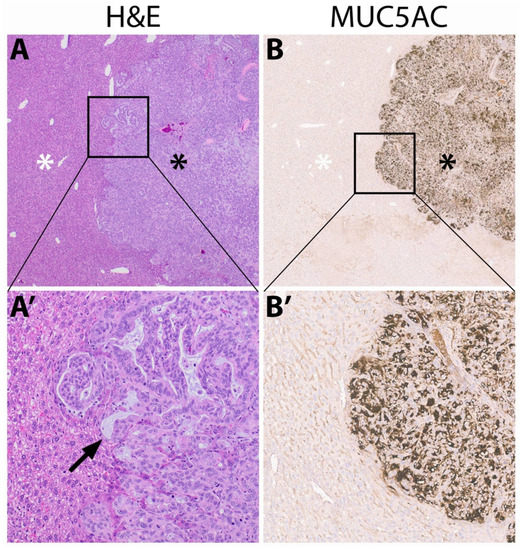 Highly Selective Targeting of Pancreatic Cancer in the Liver with a ...