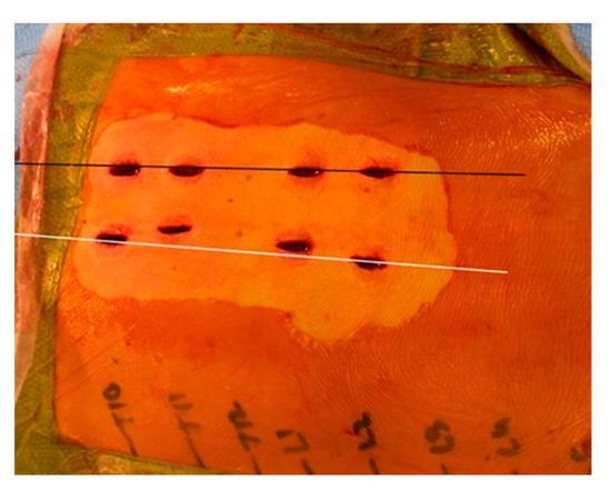JPM | Free Full-Text | Patient Perceptions of Paramedian Minimally ...