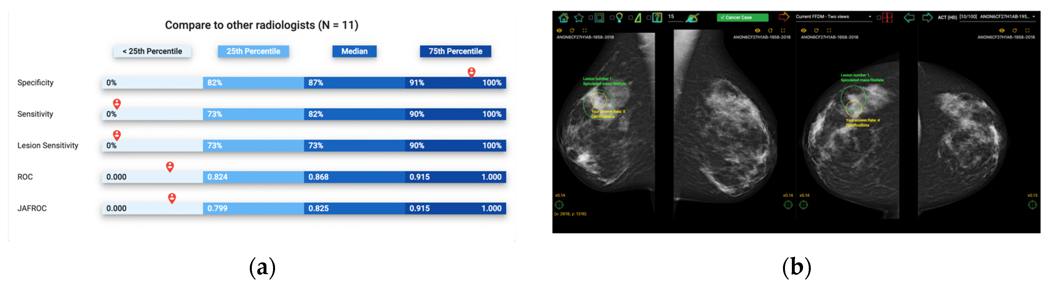 Using Radiomics-Based Machine Learning to Create Targeted Test Sets to ...