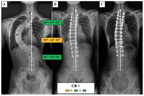 JPM | Free Full-Text | Apical Vertebras Distribution Modifier for ...