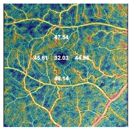 Reduced Vessel Density and Enlarged Foveal Avascular Zone in the Macula ...