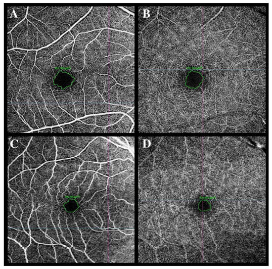 Reduced Vessel Density and Enlarged Foveal Avascular Zone in the Macula ...