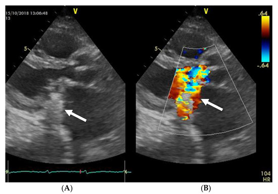 Diagnosis of Left-Sided Mechanical Prosthetic Valve Thrombosis: A ...