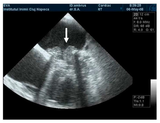JPM | Free Full-Text | Diagnosis of Left-Sided Mechanical Prosthetic ...