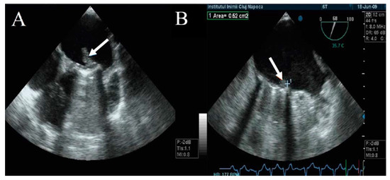 Diagnosis of Left-Sided Mechanical Prosthetic Valve Thrombosis: A ...