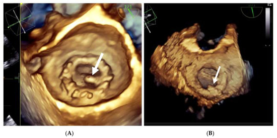 Diagnosis of Left-Sided Mechanical Prosthetic Valve Thrombosis: A ...