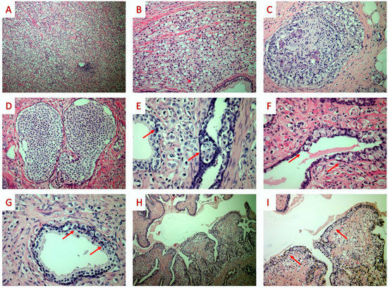 A Case of Prostatic Signet-Ring Cell-like Carcinoma with Pagetoid ...