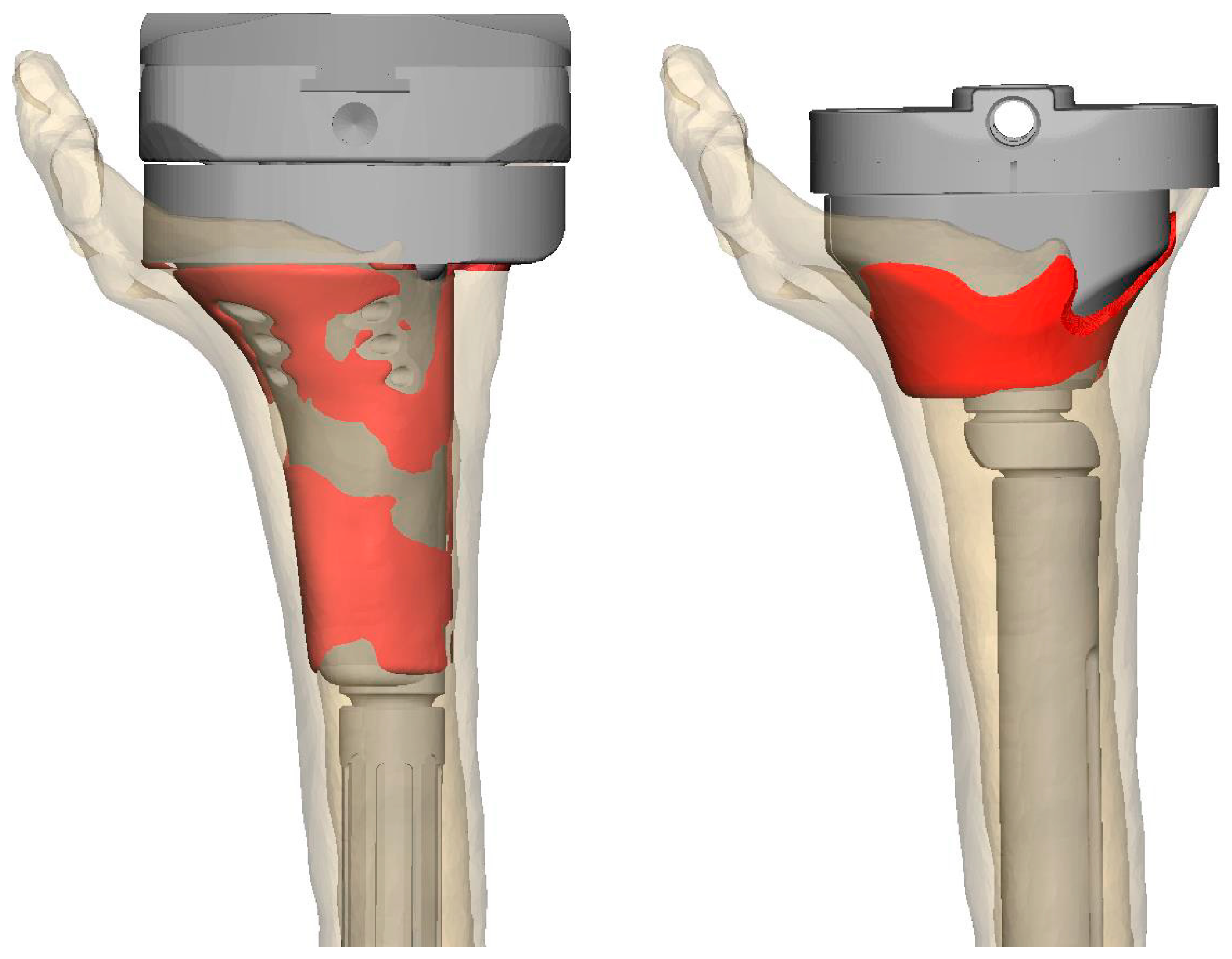 Custom-Made Metaphyseal Sleeves in “Beyond” AORI III Defects for ...