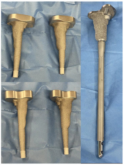 Custom-Made Metaphyseal Sleeves in “Beyond” AORI III Defects for ...