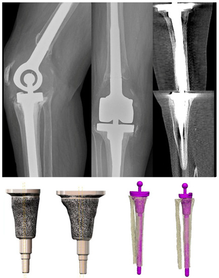 Custom-Made Metaphyseal Sleeves in “Beyond” AORI III Defects for ...