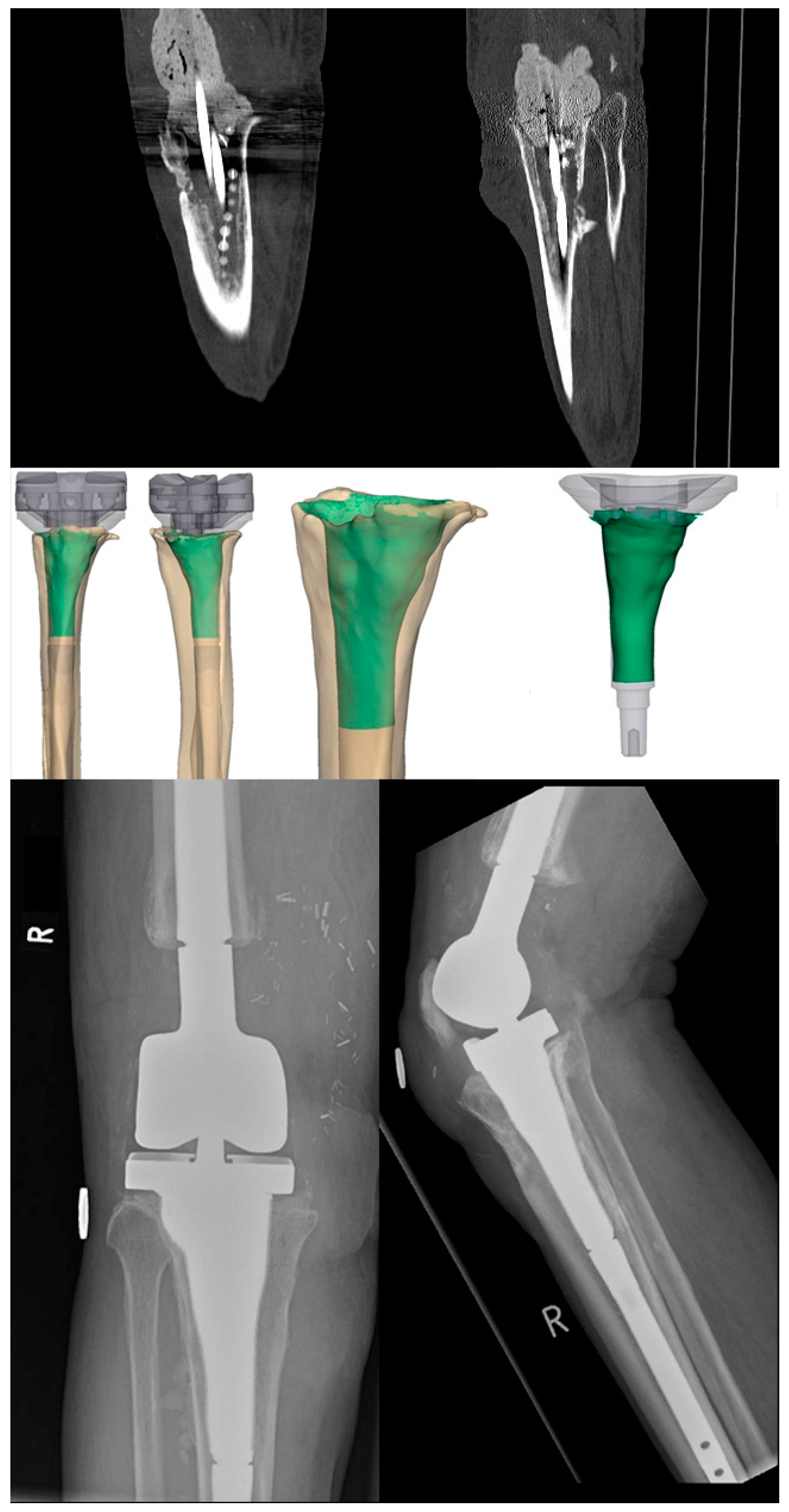 Custom-Made Metaphyseal Sleeves in “Beyond” AORI III Defects for ...