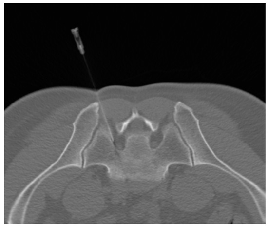 Previous Lumbar Spine Surgery Decreases the Therapeutic Efficacy of ...