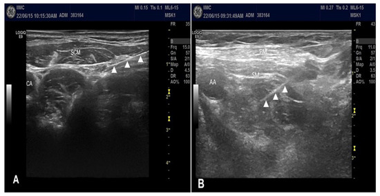 Combined Intermediate Cervical Plexus and Costoclavicular Block for Arthroscopic Shoulder ...