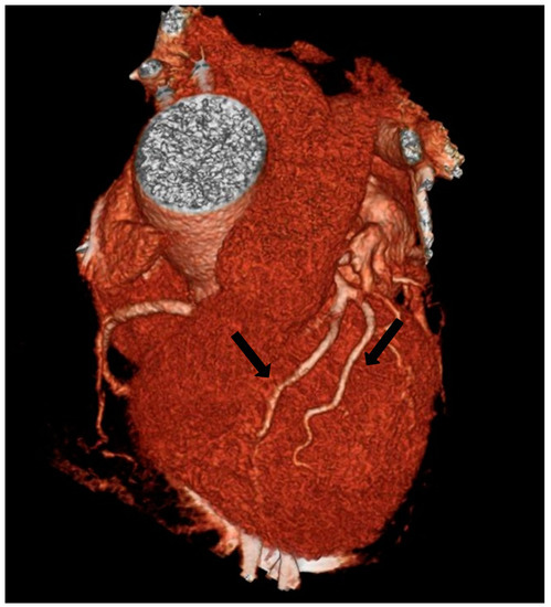 The Role of Coronary CT Angiography in the Evaluation of Dual Left ...