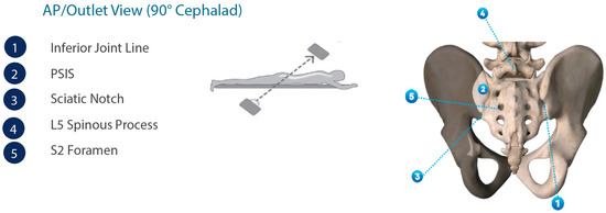 Minimally Invasive Postero-Inferior Sacroiliac Joint Fusion: Surgical ...