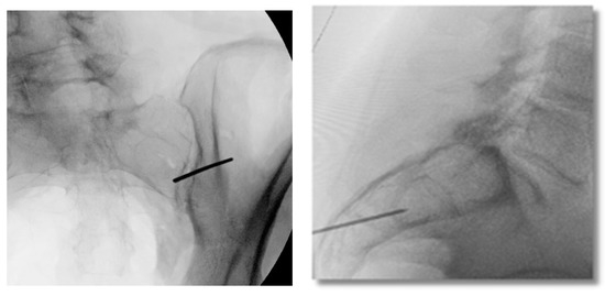 Minimally Invasive Postero-Inferior Sacroiliac Joint Fusion: Surgical ...