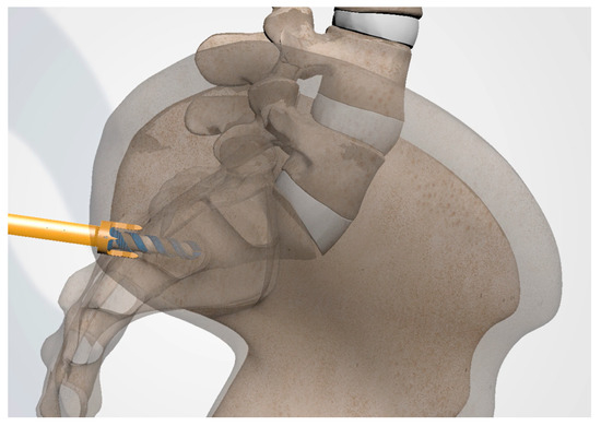 Minimally Invasive Postero-Inferior Sacroiliac Joint Fusion: Surgical ...