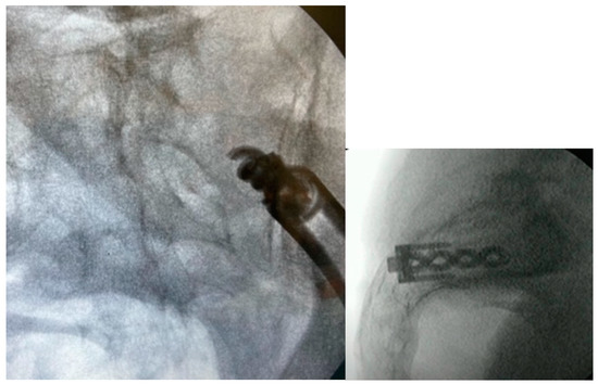 Minimally Invasive Postero-Inferior Sacroiliac Joint Fusion: Surgical ...