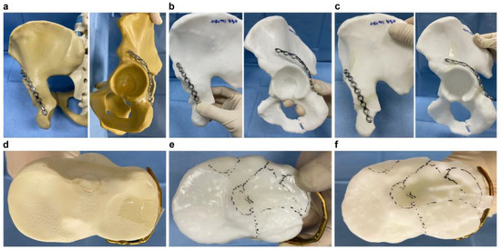 The Clinical Efficacy of Contouring Periarticular Plates on a 3D ...