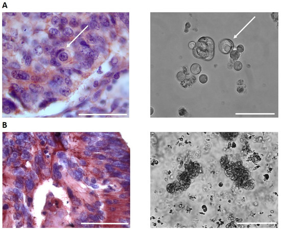 Cell-in-Cell Structures in Gastrointestinal Tumors: Biological ...