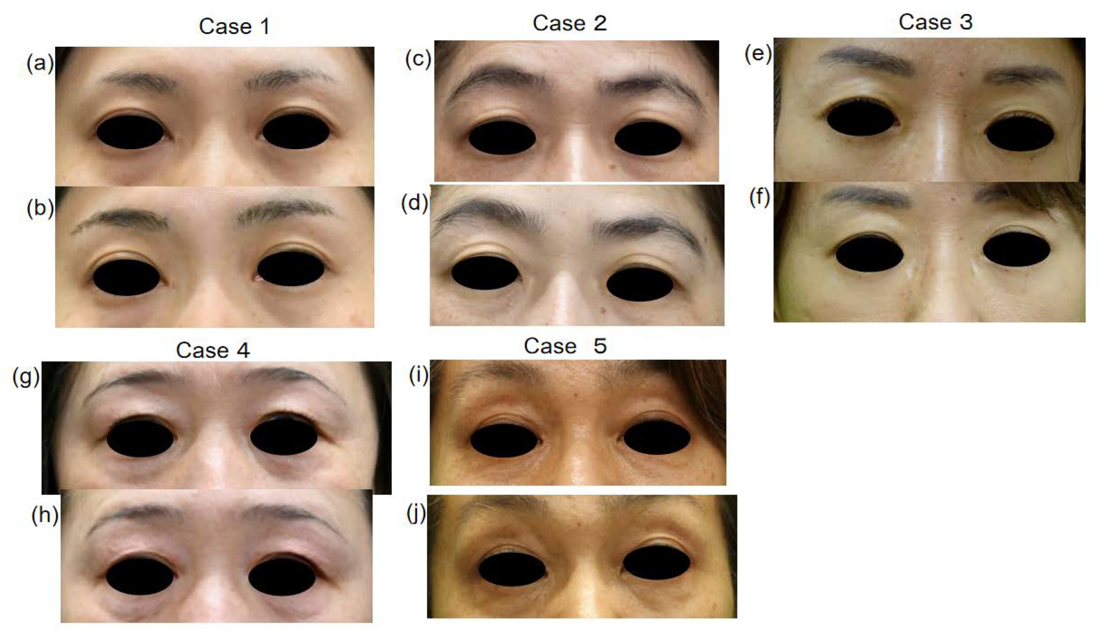 A Single Intradermal Injection of Autologous Adipose-Tissue-Derived ...