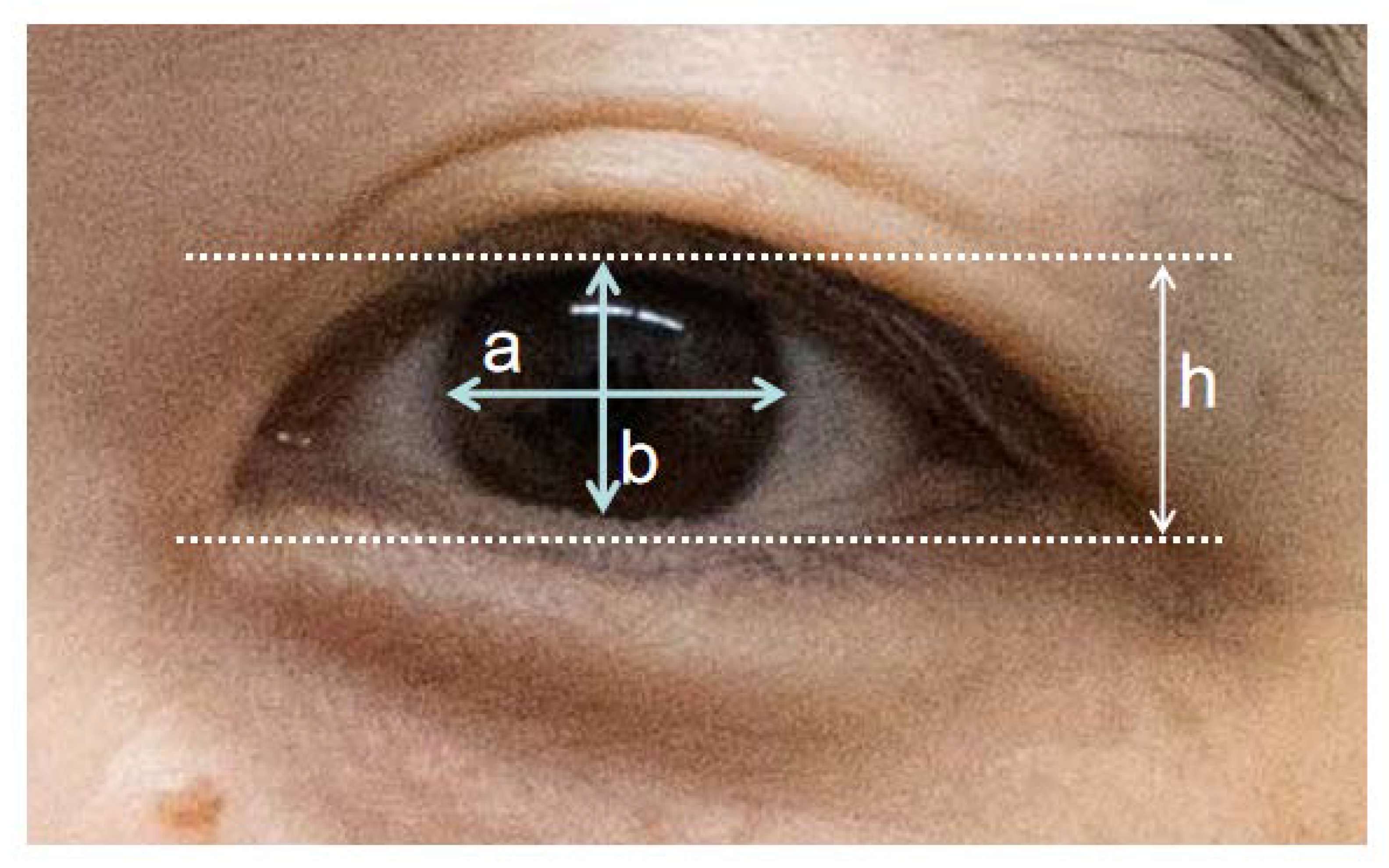 A Single Intradermal Injection of Autologous Adipose-Tissue-Derived ...