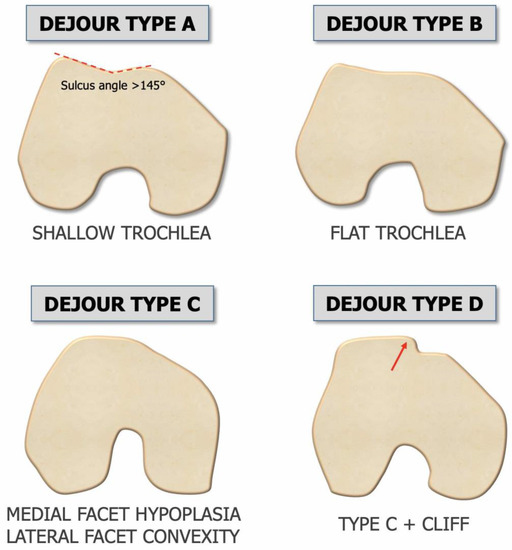 Framing Patellar Instability: From Diagnosis to the Treatment of the ...