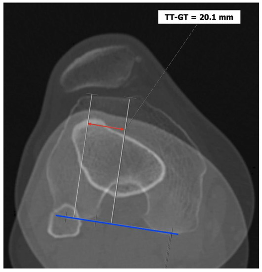 Framing Patellar Instability: From Diagnosis to the Treatment of the ...