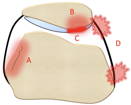 Framing Patellar Instability: From Diagnosis to the Treatment of the ...