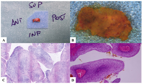 Potential Use of Vivascope for Real-Time Histological Evaluation in ...