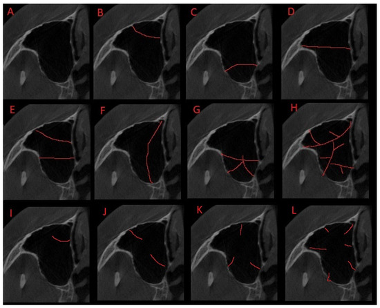The CBCT Retrospective Study on Underwood Septa and Their Related ...