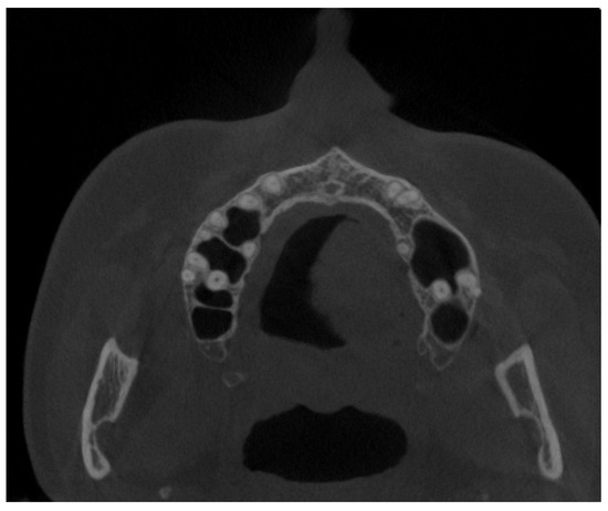 The CBCT Retrospective Study on Underwood Septa and Their Related ...