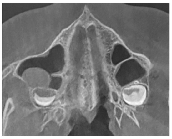 The CBCT Retrospective Study on Underwood Septa and Their Related ...