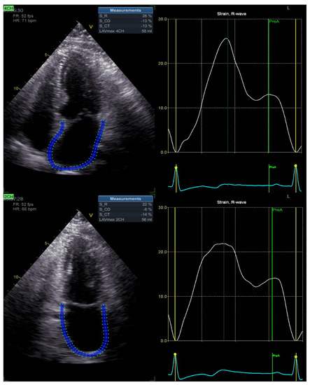 Acute Changes on Left Atrial Function during Incremental Exercise in ...