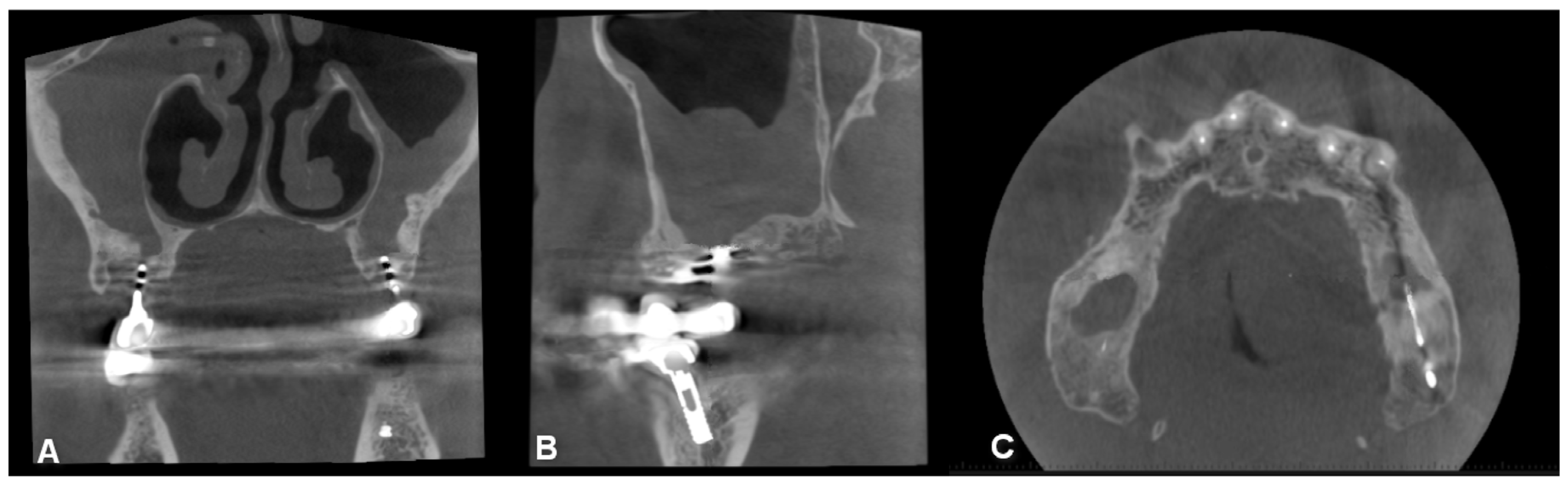 Jpm Free Full Text Management Of Odontogenic Sinusitis Results